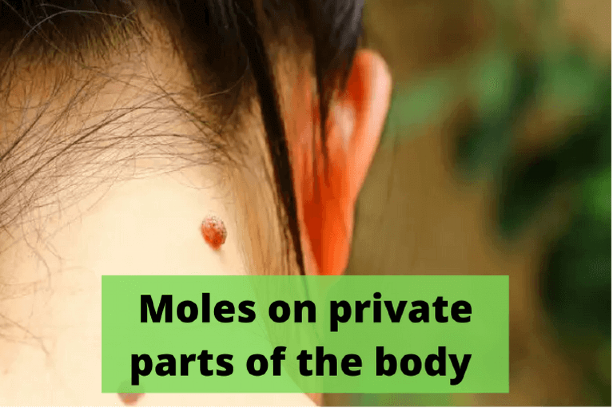 How to Remove Moles from the Private Part of the Body?
