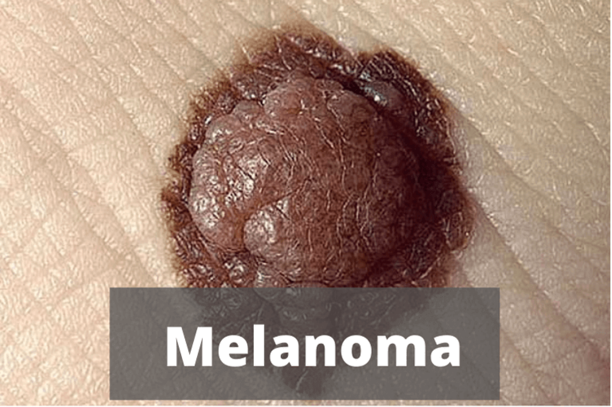 How to Remove Moles from the Private Part of the Body?