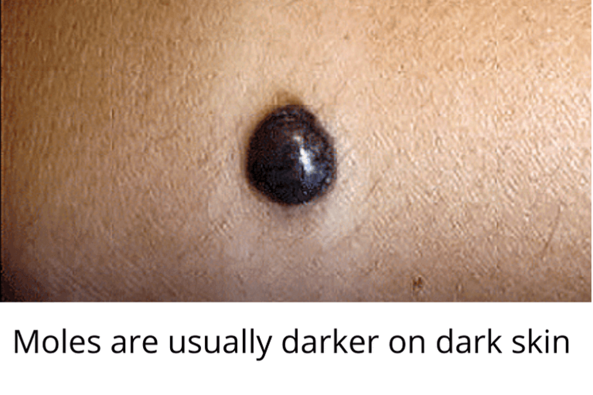 Skin Moles To Worry About A Complete Guide With Skin Moles Pictures Skin Moles To Worry About A Complete Guide With Skin Moles Pictures