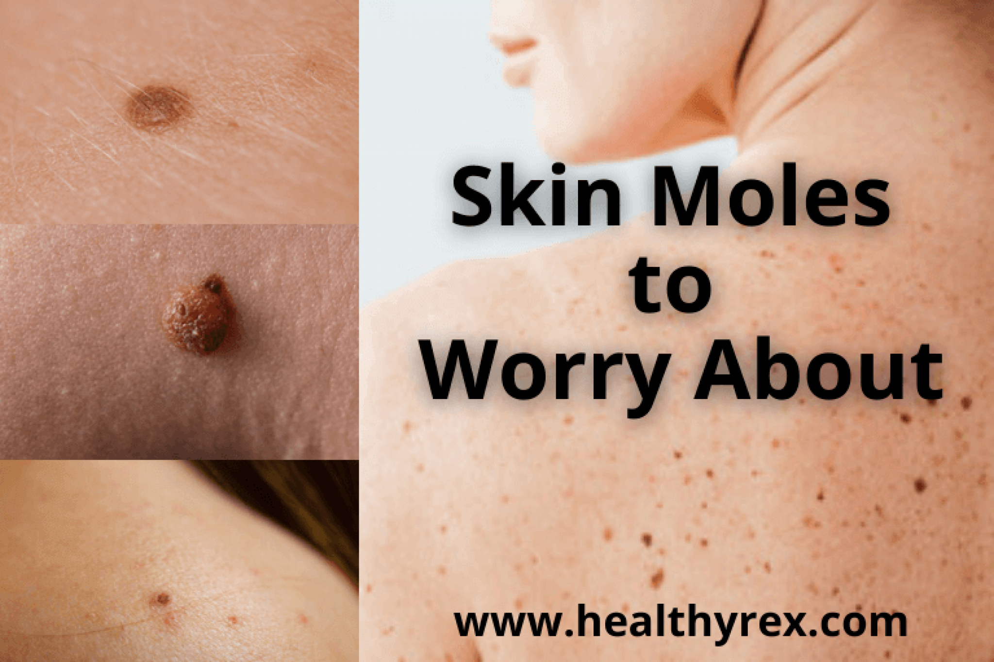 Skin Moles To Worry About A Complete Guide With Skin Moles Pictures Skin Moles To Worry About A Complete Guide With Skin Moles Pictures