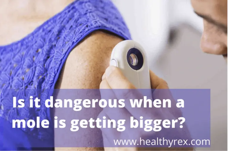 Skin Moles to Worry About – A Complete Guide With Skin Moles Pictures