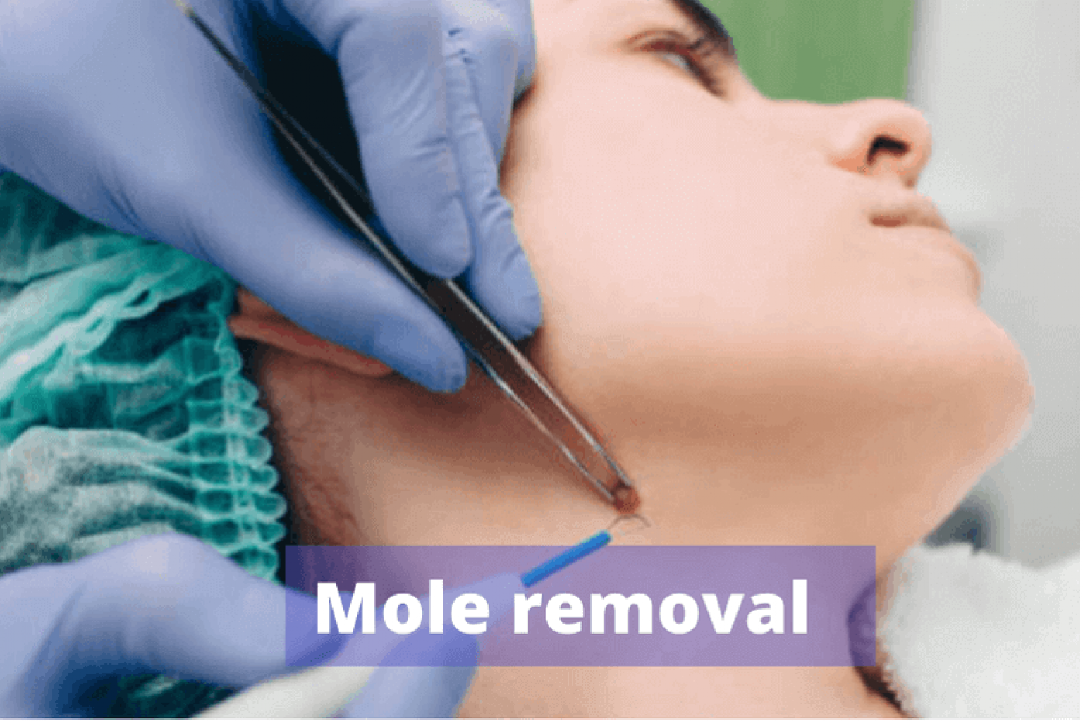 Skin Moles to Worry About – A Complete Guide With Skin Moles Pictures