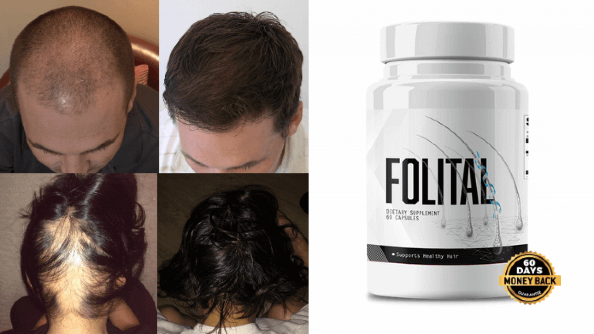 Folital Reviews - Legit Or Scam? Hair Regrowth Supplement!